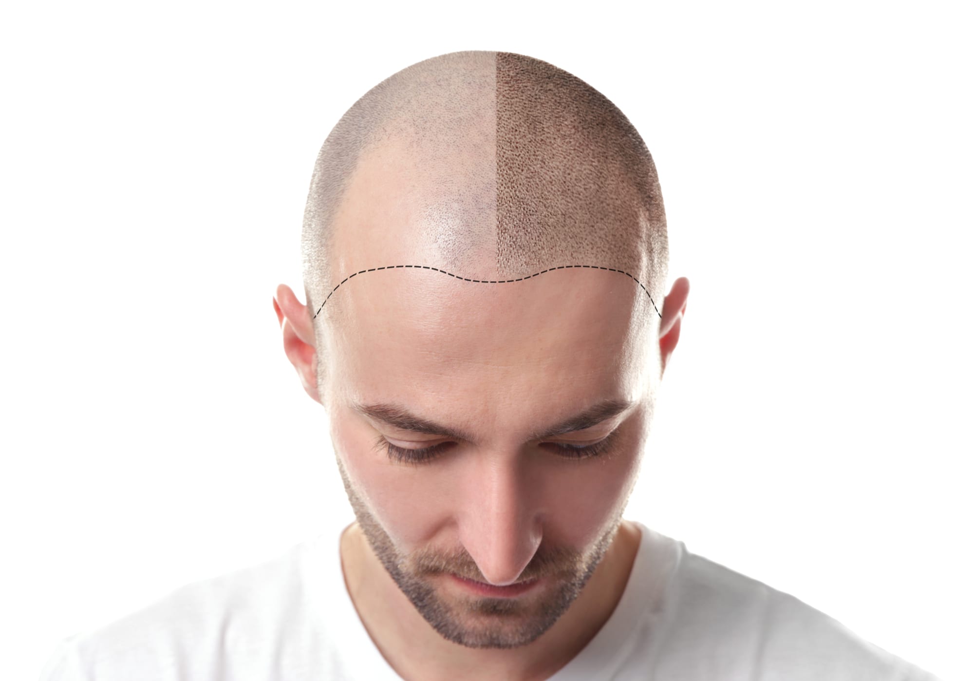 Micropigmentation The Hair Loss Solution You ve Been Searching For Micropigmentation The Hair Loss Solution You ve Been Searching For
